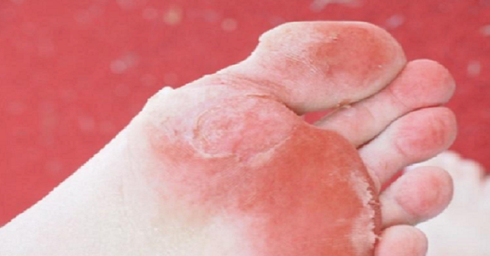 Callos en los pies y la solución más práctica - Motril Digital